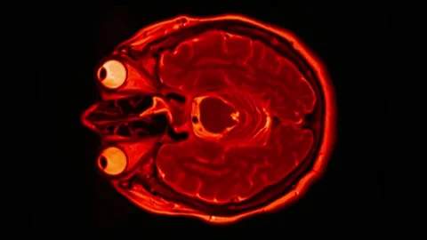 Mri Scan. Human Brain. RMN Scan. | Stock Video | Pond5
