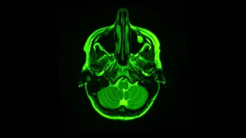 Mri Scan. Human Brain. RMN Scan. | Stock Video | Pond5