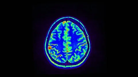 Mri Scan. Human Brain. RMN Scan. | Stock Video | Pond5