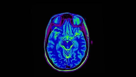 Mri Scan. Human Brain. RMN Scan. | Stock Video | Pond5
