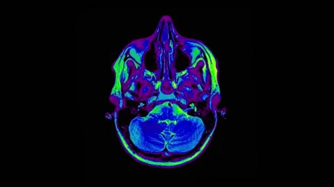 Mri Scan. Human Brain. RMN Scan. | Stock Video | Pond5