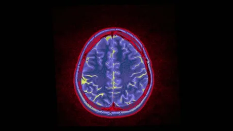 Mri Scan. Human Brain. RMN Scan. | Stock Video | Pond5