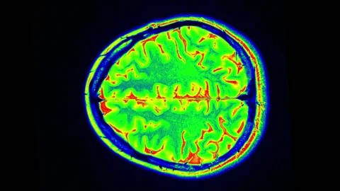 Mri Scan. Human Brain. RMN Scan. | Stock Video | Pond5