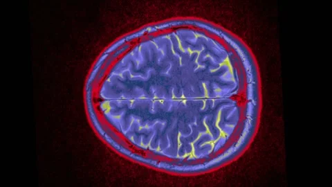 Mri Body Scan Stock Video Footage | Royalty Free Mri Body Scan Videos ...