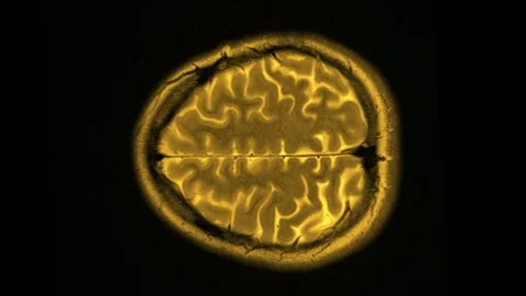 Mri Scan. Human Brain. RMN Scan. | Stock Video | Pond5