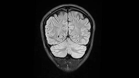 Mri Scan. Human Brain. RMN Scan. | Stock Video | Pond5