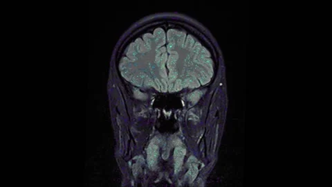 Mri Scan. Human Brain. RMN Scan. | Stock Video | Pond5