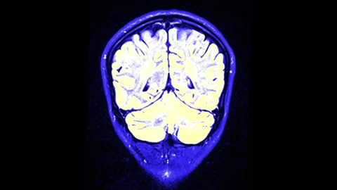 Mri Scan. Human Brain. RMN Scan. | Stock Video | Pond5