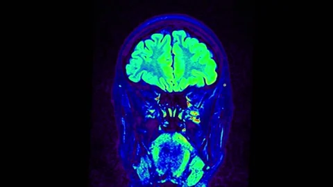 Mri Scan. Human Brain. RMN Scan. | Stock Video | Pond5