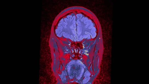 Mri Scan. Human Brain. RMN Scan. | Stock Video | Pond5