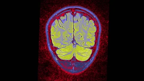Mri Scan. Human Brain. RMN Scan. | Stock Video | Pond5
