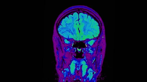 Mri Scan. Human Brain. RMN Scan. | Stock Video | Pond5