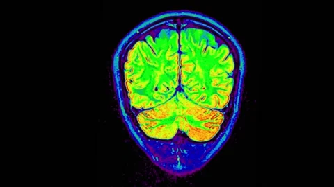 Mri Scan. Human Brain. RMN Scan. | Stock Video | Pond5