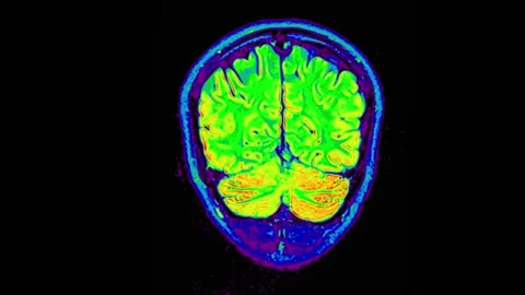 Mri Scan. Human Brain. RMN Scan. | Stock Video | Pond5