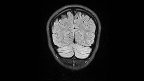 Mri Brain Scan Stock Video Footage | Royalty Free Mri Brain Scan Videos ...