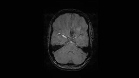 Mri Scan. Human Brain. RMN Scan. | Stock Video | Pond5