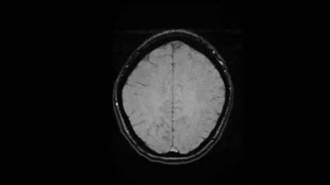 Mri Scan. Human Brain. RMN Scan. | Stock Video | Pond5