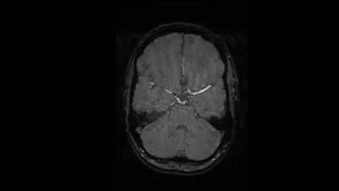 Mri Scan. Human Brain. RMN Scan. | Stock Video | Pond5