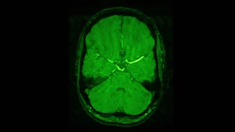 Mri Scan. Human Brain. RMN Scan. | Stock Video | Pond5