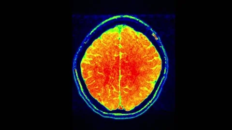 Mri Scan. Human Brain. RMN Scan. | Stock Video | Pond5