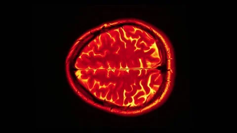 Mri Scan. Human Brain. RMN Scan. | Stock Video | Pond5