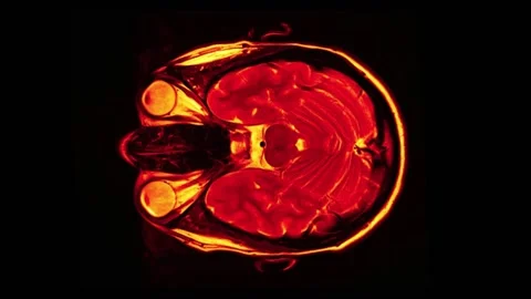 Mri Scan. Human Brain. RMN Scan. | Stock Video | Pond5