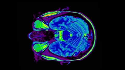 Mri Scan. Human Brain. RMN Scan. | Stock Video | Pond5