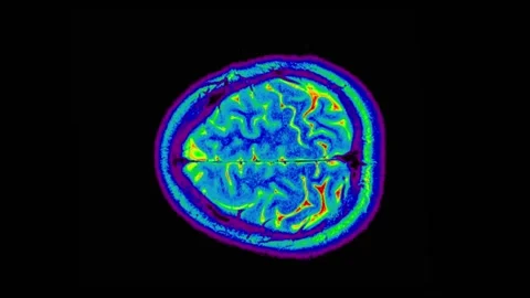 Mri Scan. Human Brain. RMN Scan. | Stock Video | Pond5