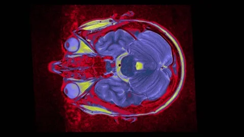 Mri Scan. Human Brain. RMN Scan. | Stock Video | Pond5