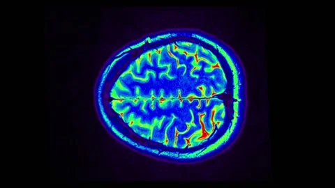 Mri Scan. Human Brain. RMN Scan. | Stock Video | Pond5