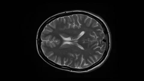 Mri Scan. Human Brain. RMN Scan. | Stock Video | Pond5