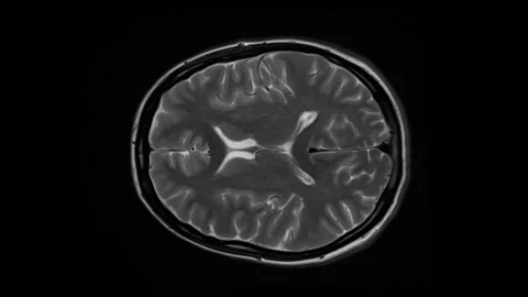 Mri Scan. Human Brain. RMN Scan. | Stock Video | Pond5