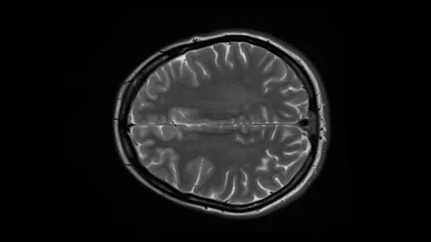 Mri Scan. Human Brain. RMN Scan. | Stock Video | Pond5
