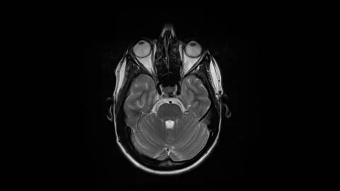Mri Scan. Human Brain Scan. | Stock Video | Pond5