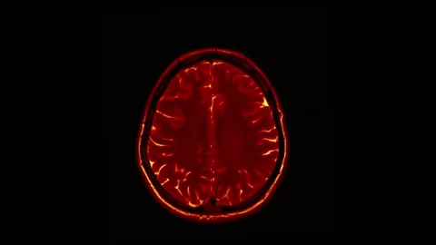 Mri Scan. Human Brain Scan. | Stock Video | Pond5
