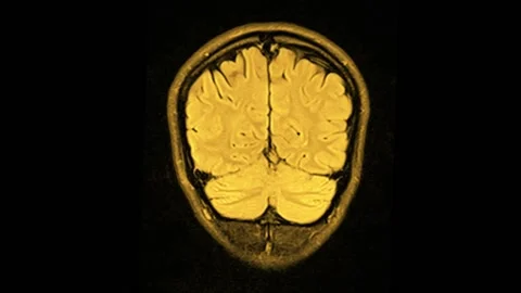Mri Scan. Human Brain Scan. | Stock Video | Pond5