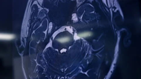 MRI scanning of head. Screen with the bi... | Stock Video | Pond5