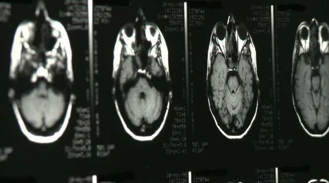 multiple xray mri brain scans | Stock Video | Pond5