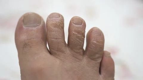 neglected male toes, fungus toes, fungal... | Stock Video | Pond5