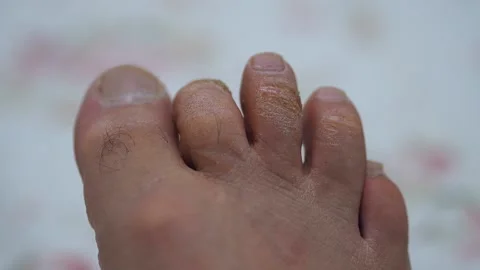 neglected male toes, fungus toes, fungal... | Stock Video | Pond5