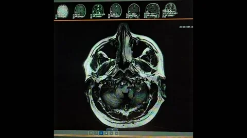 Nocardia brain abscesses and cysticercos... | Stock Video | Pond5