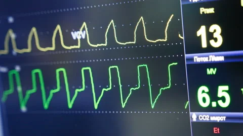 Observation of patient's life signs at t... | Stock Video | Pond5