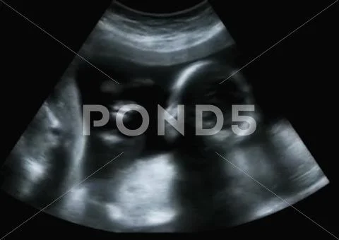 Photograph: Obstetric Ultrasonography Ultrasound Echography of a first ...