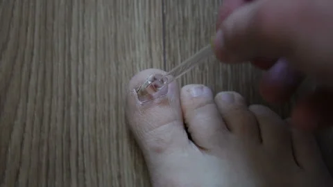 Onycholysis - detachment of the nail fro... | Stock Video | Pond5