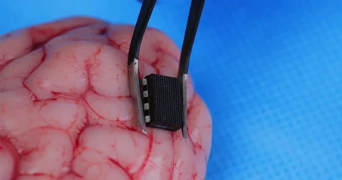 Brain Treatment Stock Video Footage | Royalty Free Brain Treatment ...