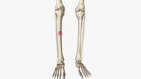 open fracture, also called a compound fr... | Stock Video | Pond5