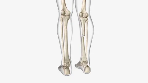open fracture, also called a compound fr... | Stock Video | Pond5