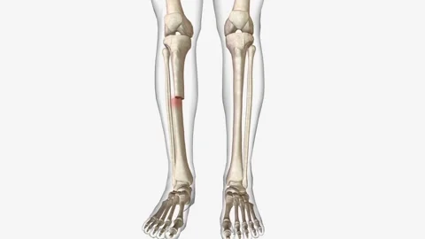 open fracture, also called a compound fr... | Stock Video | Pond5