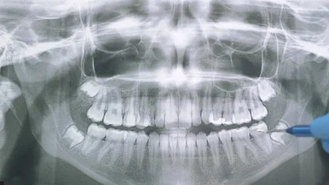 Orthopantomography, OPG X-ray DR digital... | Stock Video | Pond5