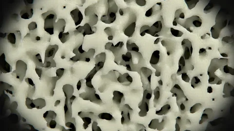 Osteoporosis weakening bone, animation | Stock Video | Pond5